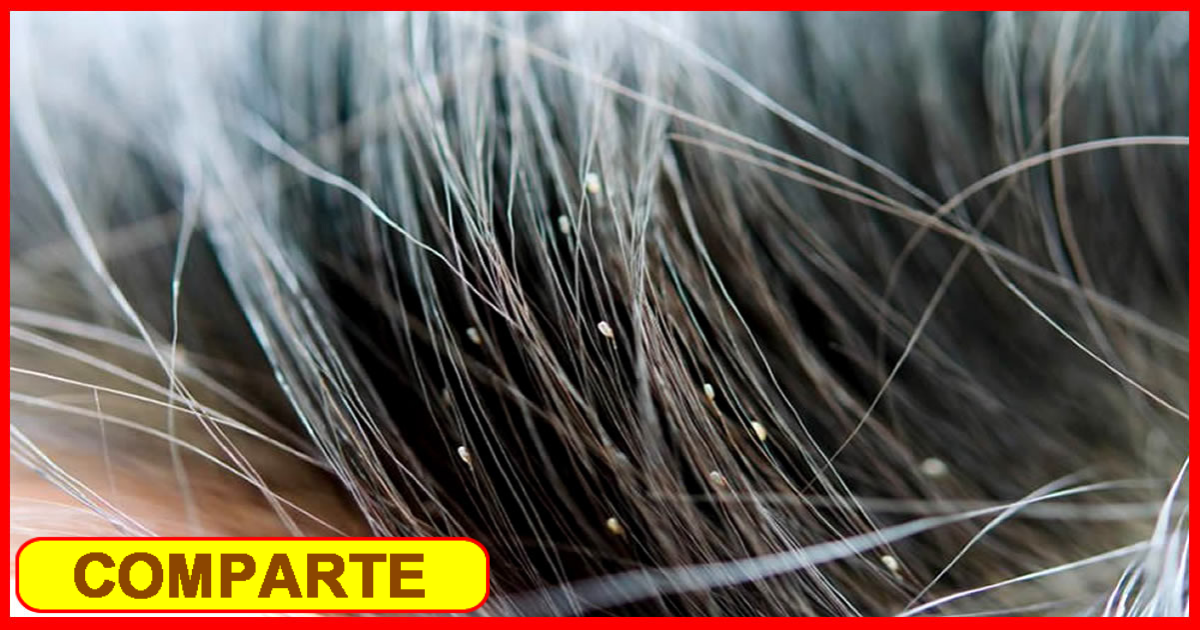 → Soñar Con Liendres - Significados, Mensajes E Interpretaciones